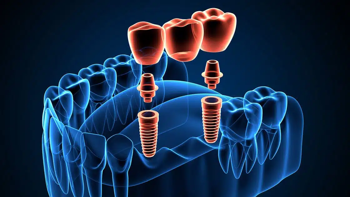 Dental Implants – Humphries Family Dentistry